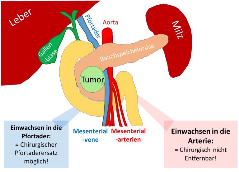 Pankreaskarzinom-Resektabilität-1 – antireflux.info