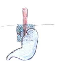 Thoraxmagen: Operative Versorgung – antireflux.info