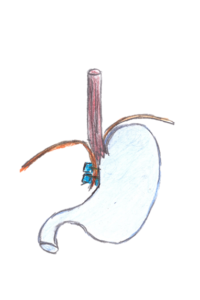 Thoraxmagen: Operative Versorgung – antireflux.info